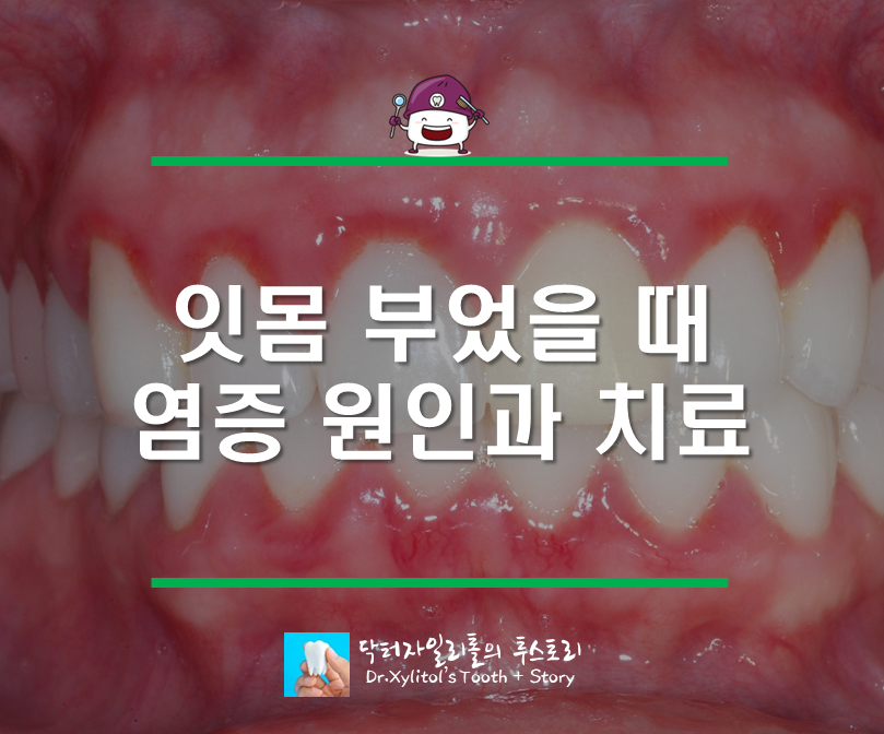 잇몸 부었을때 염증 원인과 치료 네이버 포스트