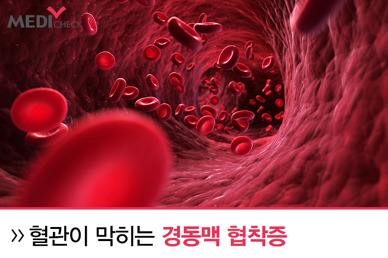 혈관이 막히는 경동맥 협착증과 초음파검사 네이버 포스트