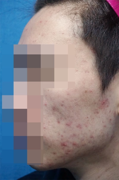 한방피부과 여드름한의원 만성 여드름치료 네이버 포스트