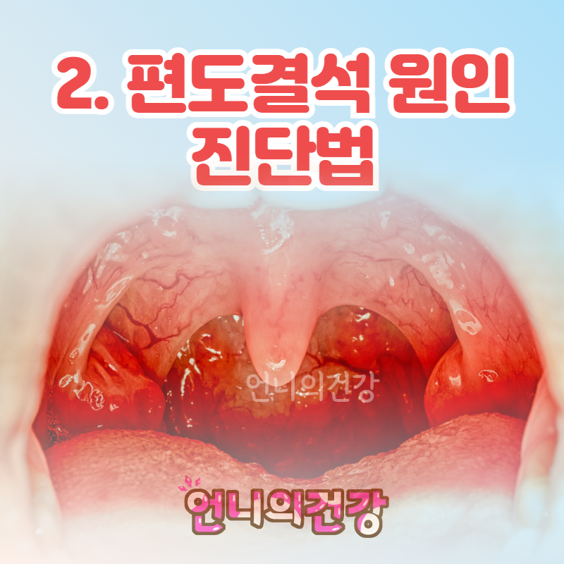 편도염 증상 및 관리 방법 예방이 가장 중요해요 신데렐라
