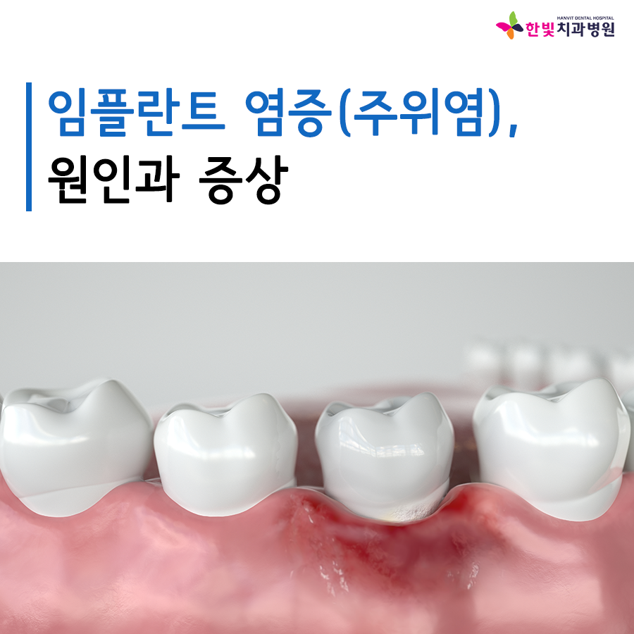 임플란트 염증주위염 원인과 증상 네이버 포스트