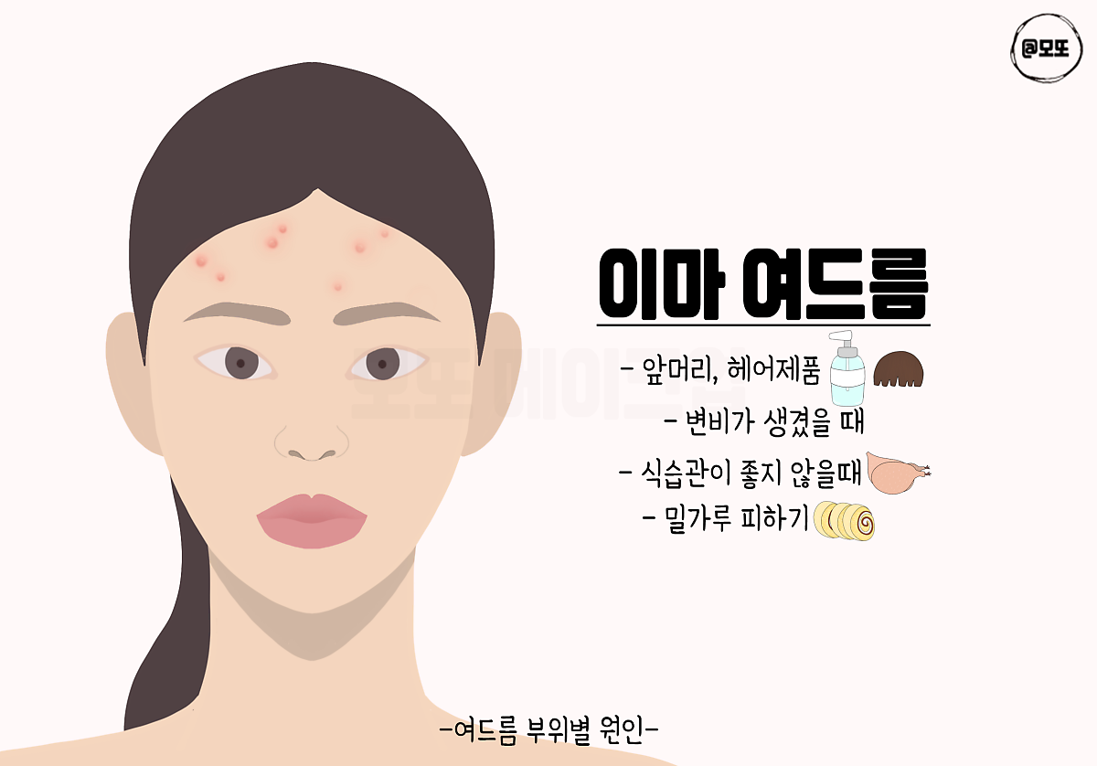 성인 얼굴 여드름 부위별 원인관리법이마 코 턱 코밑 입주변 트러블 이슈칼럼