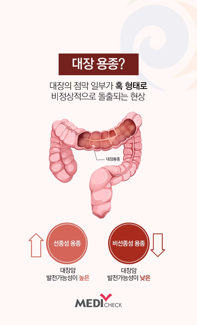 대장암 일으키는 선종성 용종 검사와 예방법은 네이버 포스트
