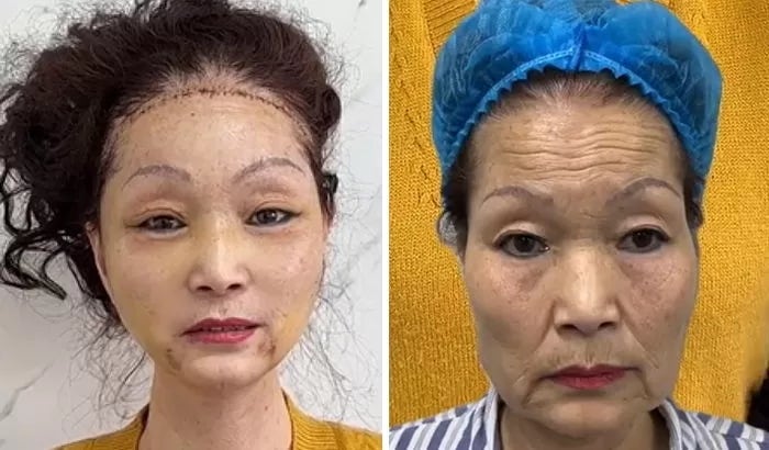 안면거상수술 후 30대라 해도 믿을 만큼 젊어진 61세 중국 여성의 얼굴 변화 네이버 포스트