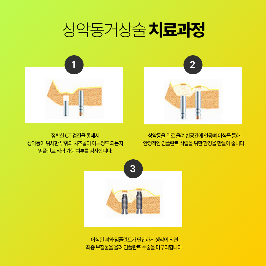 치과 임플란트 치조골 부족할 때 뼈이식 임플란트와 상악동 거상술 네이버 포스트