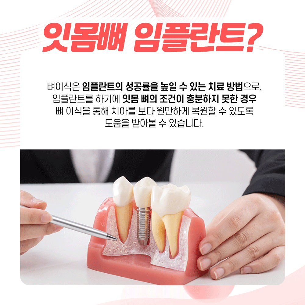 치과 임플란트 부족한 뼈를 채우는 방법이란 뼈이식 임플란트 추천하는 경우 네이버 포스트
