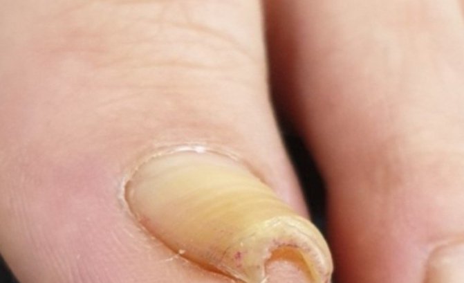 발바닥 발가락 무좀 증상 원인 손톱무좀 발톱무좀 무좀약 치료하기 위해 네이버 포스트