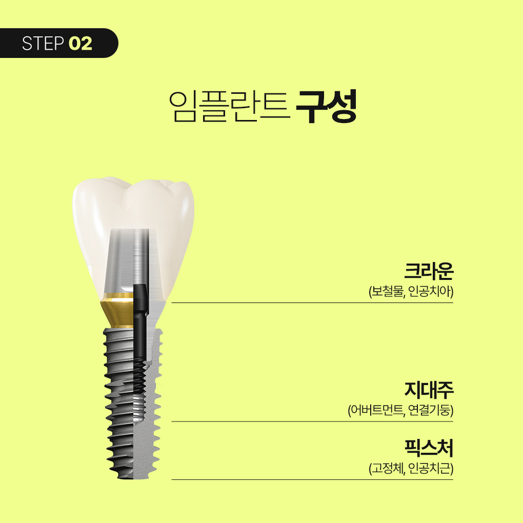 대전치과 임플란트 뼈이식 임플란트 어떤 경우에 할 수 있나요 네이버 포스트