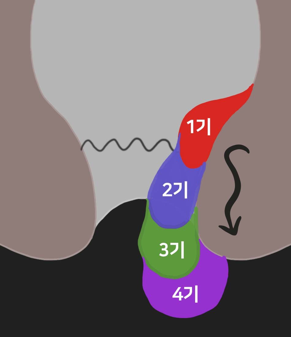 치핵 증상 탈출 방법 Ft치핵 자연치료 내치핵 외치핵 네이버 포스트