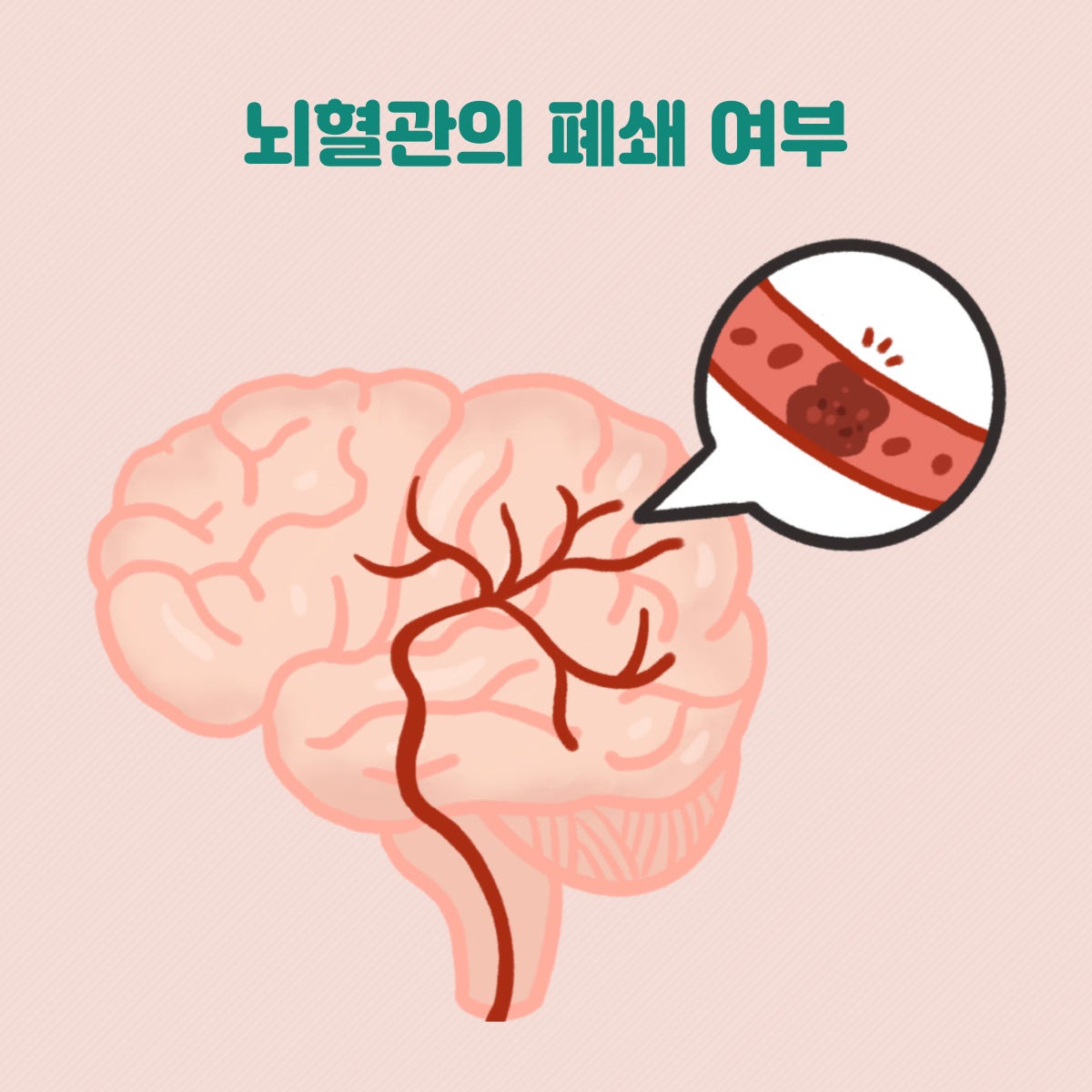뇌혈류장애 뇌혈류초음파로 확인가능한가 네이버 포스트