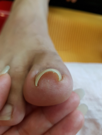 내성발톱 자가치료 엄지발톱통증 엄지발톱염증 네이버 포스트